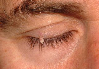 Squamous Papilloma Eyelid Eyelid Lesions For Medical Students أ.د.