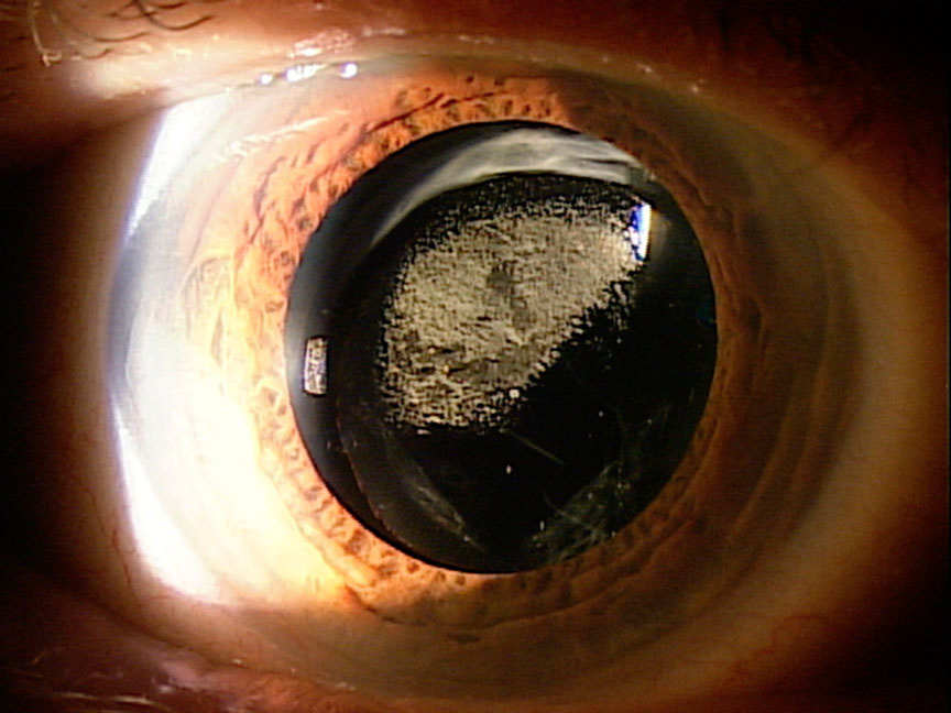 YAG laser capsulotomy | Neil Modi